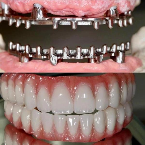 Quality Dental Hybird Malo Implant Bridge Professional Perfect Fit FDA Certified for sale