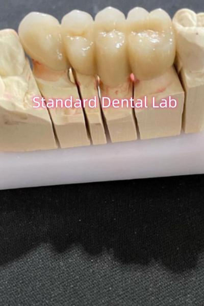 Quality Cast PFM Non Precious CoCr Metal Porcelain Bridge Dental CCM for sale