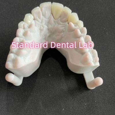 Quality Stars' Smile Dental Teeth Emax Zirconia Laminate Veneers 0.6mm for sale
