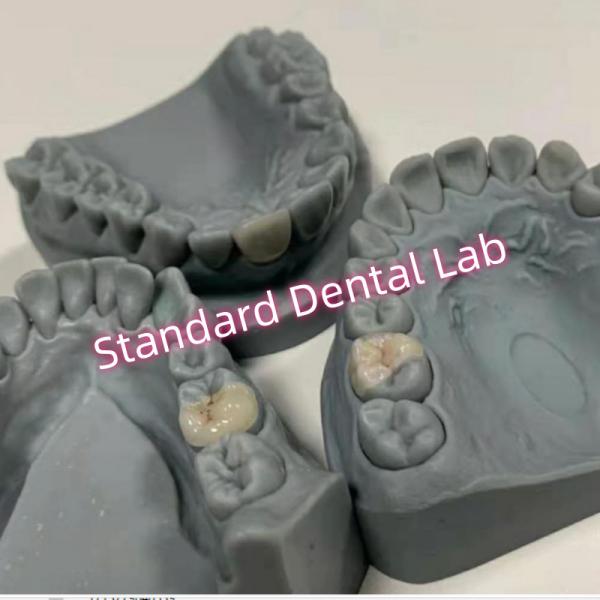 Quality Cosmetic Natural Looking Porcelain Inlays And Onlays Overlays for sale
