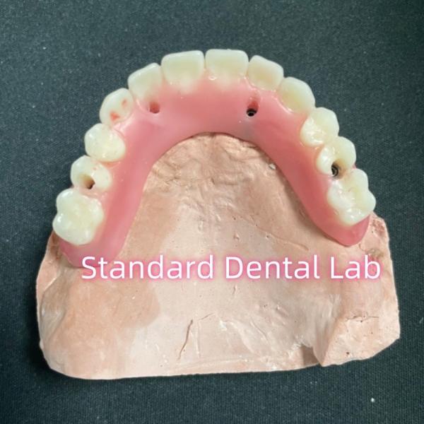 Quality Acrylic Partial Implant Over Denture Titianium Bar Full Denture Teeth Set Up Screw Retained for sale