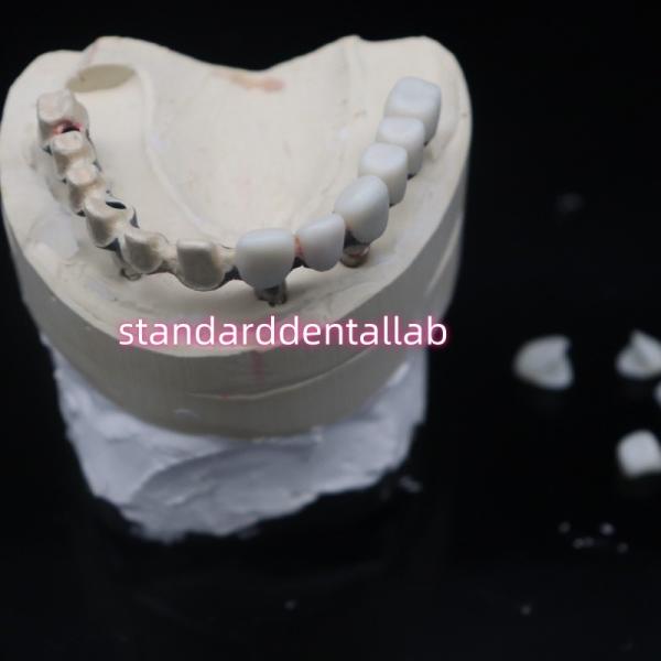 Quality Full Arch Malo Bridge Dental Restoration Zirconia Crowns With Gum Poecelian for sale