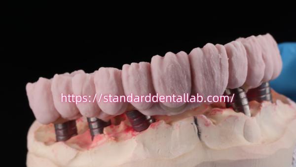 Quality Implant Supported Zirconia Bridge With Titanium Abutment High Esthetics for sale
