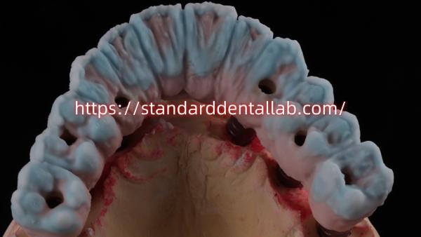 Quality Implant Supported Zirconia Bridge With Titanium Abutment High Esthetics for sale