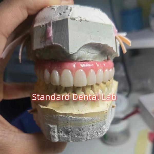 Quality Screw Retained Titanium PMMA Dental Bridge Temporary Crown for sale