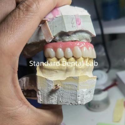 China Screw Retained Titanium PMMA Dental Bridge Temporary Crown for sale