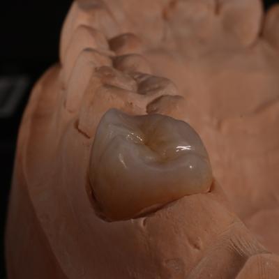 China Full Contour Translucent Zirconia Crown for Aesthetically Pleasing Results for sale