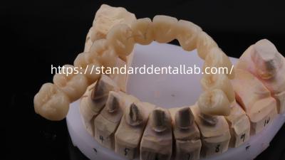 China Highly Durable And Natural-Looking Layered Porcelain For Layered Dental Zirconia Crown China Dental Lab for sale