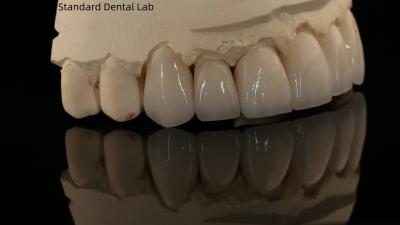 China Volledige contour Zirconia kroon en hoge esthetiek natuurlijke gebit brug 5 jaar garantie Te koop