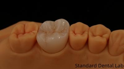 Cina Noritake Porcellana Full Contour Corona di Zirconia Personalizzata Vita Shade per Estetica Restaurazione Dentale Digitale da Dental Lab in vendita