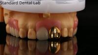 Quality Full Acrylic Dentures With Yellow Gold Teeth/Dental Temporary Acrylic Denture Ivoclar Professional FDA Approved for sale