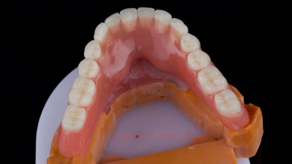 Quality Ivoclar Digital Dental Implant Bar Denture with Attachments Full Acrylic Denture for sale