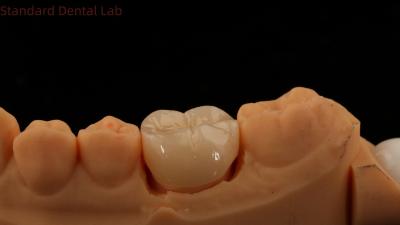 Cina Dental Digital Full Zirconia Crown con Noritake Porcellana 3D Print Model 5 anni di garanzia in vendita