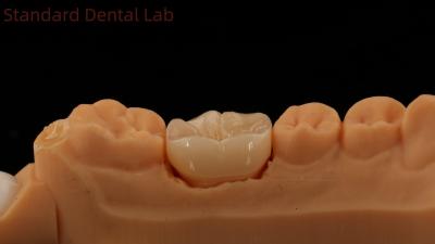 Cina Dental Digital Full Zirconia Crown con Noritake Porcellana 3D Print Model 5 anni di garanzia in vendita