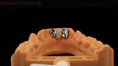 China Tandheelkundige PFM Maryland Bridge High Esthetics FDA gecertificeerd met Vita Porcelian China Dental Lab Te koop