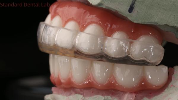 Quality Hard & Soft Night Guard Dental Mouth Guard Hard Soft Night Guard Professional for sale