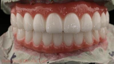 Cina Corone dentale di zirconia di alta qualità e impianto All On Four Six Full Arch / Laboratorio dentale in Cina in vendita