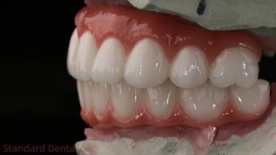 Cina Corone dentale di zirconia di alta qualità e impianto All On Four Six Full Arch / Laboratorio dentale in Cina in vendita