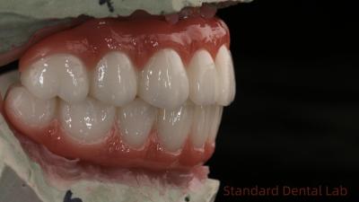 Cina Corone dentale di zirconia di alta qualità e impianto All On Four Six Full Arch / Laboratorio dentale in Cina in vendita