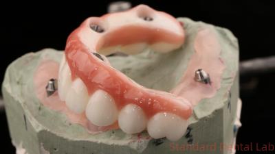 Cina Corone dentale di zirconia di alta qualità e impianto All On Four Six Full Arch / Laboratorio dentale in Cina in vendita