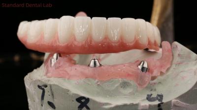 Cina Corone dentale di zirconia di alta qualità e impianto All On Four Six Full Arch / Laboratorio dentale in Cina in vendita