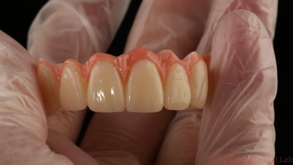 Quality Porcelain All On Four Zirconia Bridge High Esthetics Dental Implant Bridge for sale
