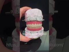 Full Arch Malo Bridge Tandheelkundige restauratie Zirconia kronen met kauwgom Poecelian China Tandheelkundige Lab