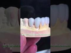Natuurlijke Emax Veneers Kroon Biocompatibiliteit Blekende schaduw met minimale voorbereiding