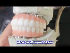 porcelain all on four zirconia bridge high esthetics dental implant bridge