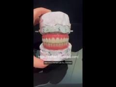 screw retained dental implant crown pfz porcelain layered zirconia