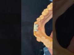 치과 PFM 메릴랜드 브리지 높은 미용 FDA 비타 포르셀리안 중국 치과 실험실과 인증