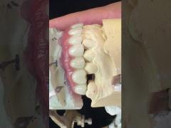Hybride titanium schroef vastgehouden tandheelkundige implantaat kroon alle op 4 tandheelkundige implantaat Zirconia brug
