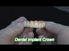 Porcelaine tout sur quatre Pont de zirconium Haut esthétique Pont d'implant dentaire