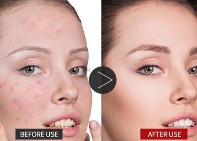 China O creme antienvelhecimento do controle do óleo para a categoria terapêutica da pele propensa da acne reduz a vermelhidão à venda