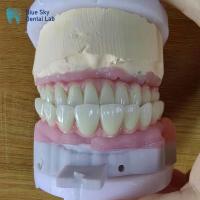China Artificial Full Arch Dental Implants Operation Cases For Surgical Procedures for sale