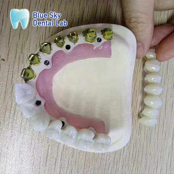 Quality Silver Gold Pure Titanium Metal Frame Dental Gold Plated Metal Frame Partial for sale