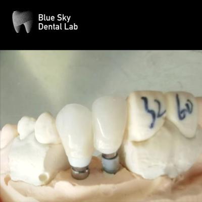 Cina Impianto dentale ipoallergenico Impianto dentale circonico in vendita