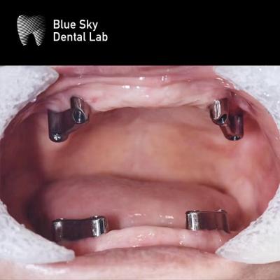 China Resin Teeth Dental Titanium Bar Removable Blue Sky Implant System for sale